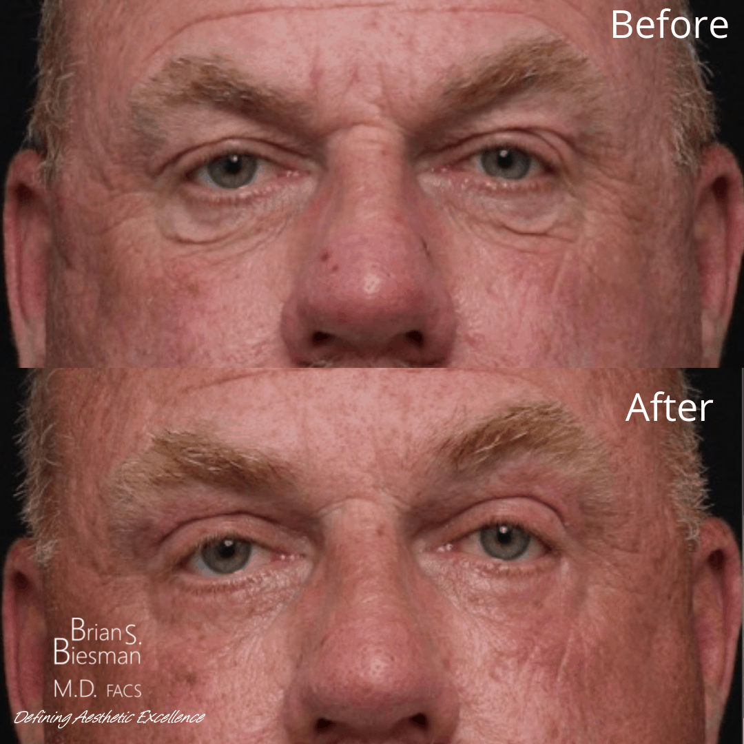 Blepharoplasty vs. Brow Lift: Which is Best for Sagging Eyelids ...
