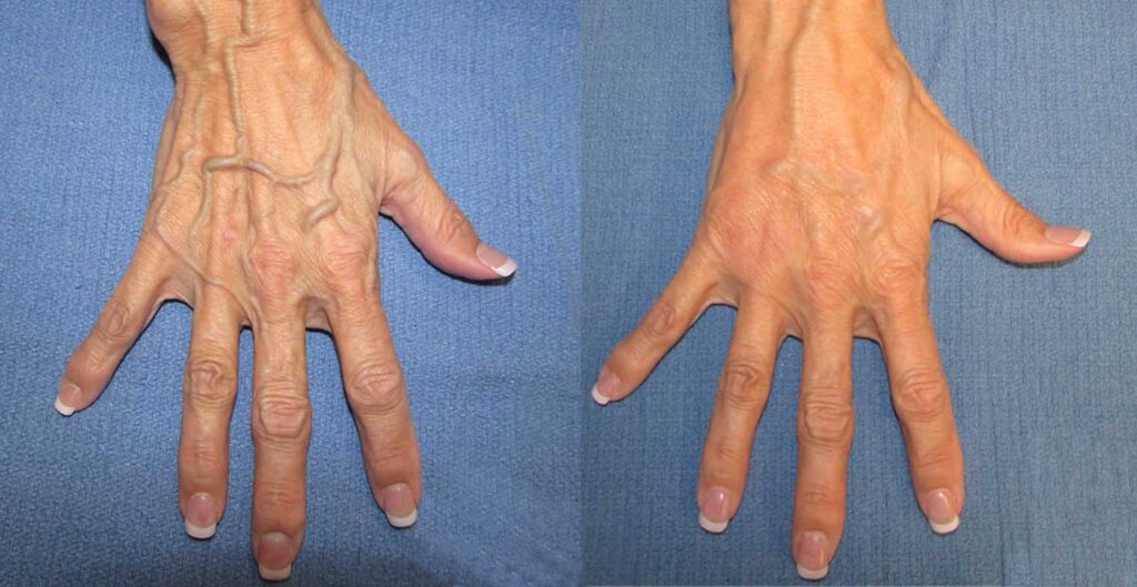 Injectable Fillers Before and After - Brian S. Biesman M.D.