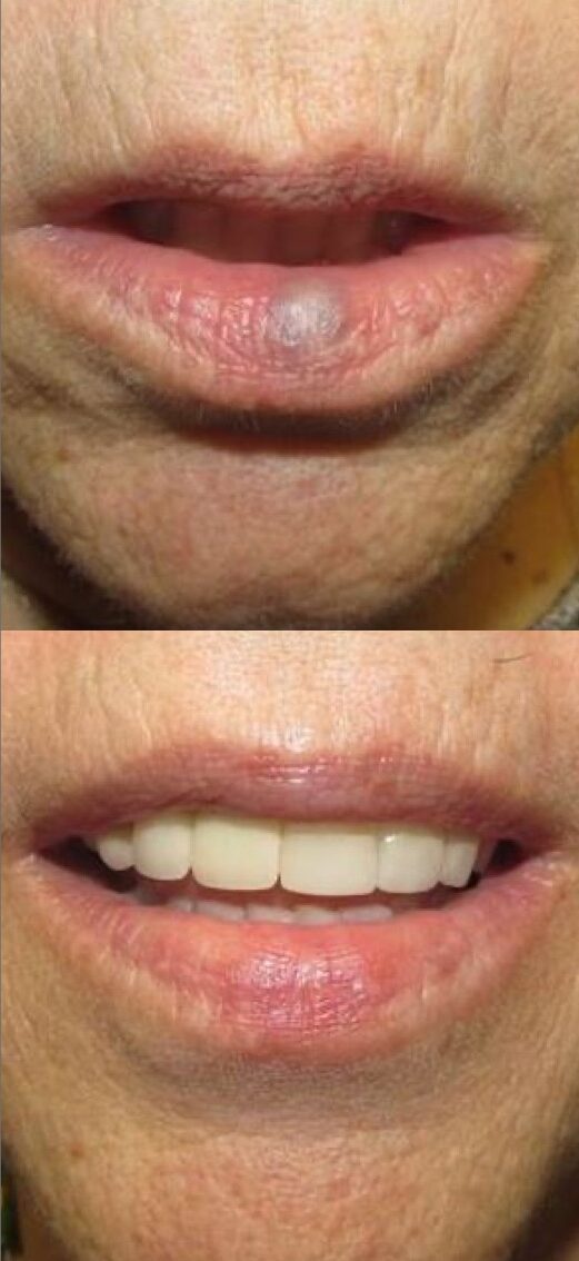 Treatment of Broken Capillaries - Brian Biesman MD | Nashville, TN