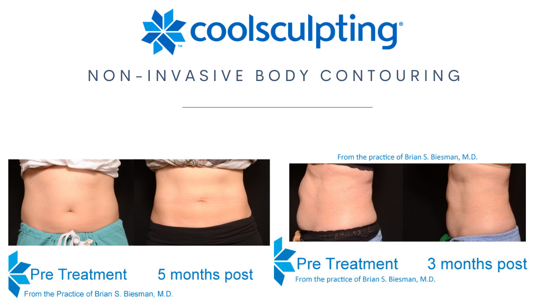 Free CoolSculpting Consultation & 25% off Treatment Plans - Dr. Biesman ...